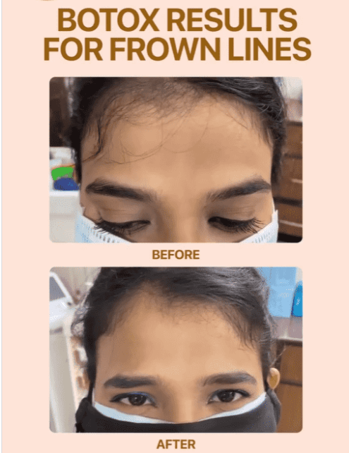 Best Botox Treatment in Delhi: Affordable Rates for 2025 - Dr. Neha Batra
